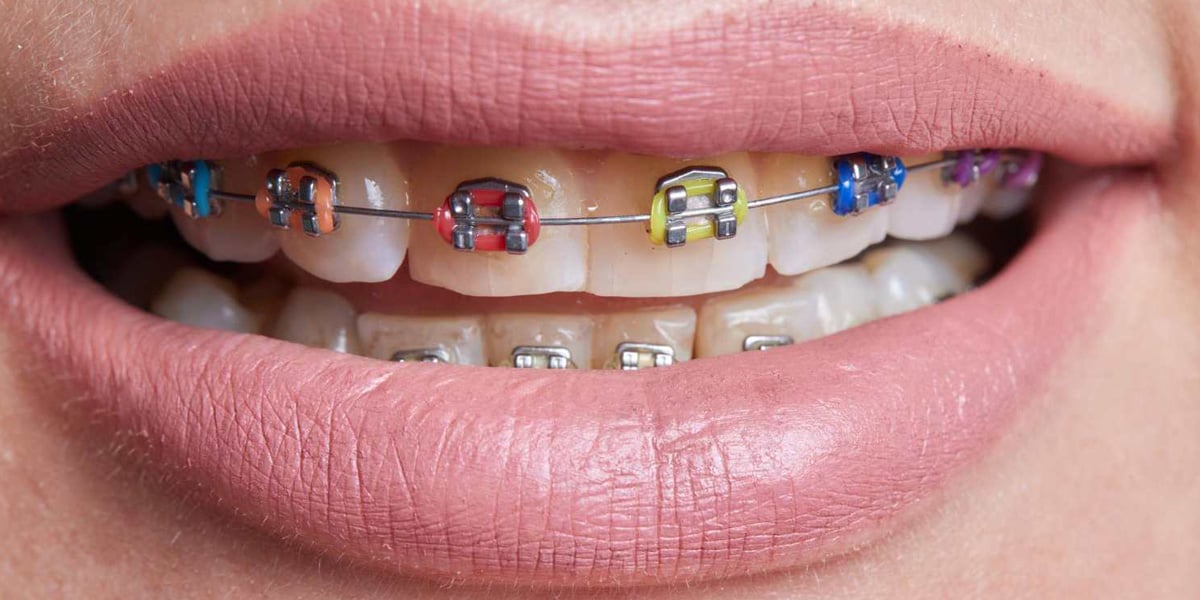 Colores de brackets: ¿Cuáles debes escoger?
