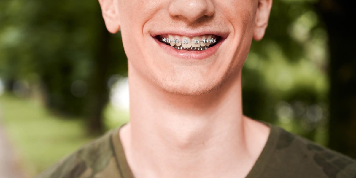 Odontología brackets: Edad recomendada para usarlos