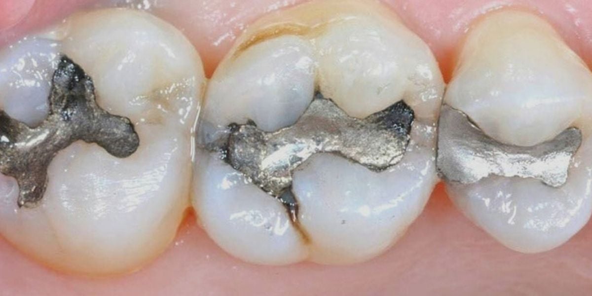 ¿Cómo quitar las caries? Amalgama o resina o empaste dental